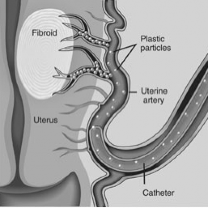 Uterine Artery Embolization – Buffalo Vascular Care